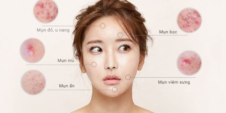 Nguyên Nhân Gây Mụn Và Cách Cải Thiện Trình Trạng Da Mụn