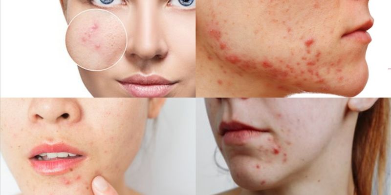 Nguyên Nhân Gây Mụn Và Cách Cải Thiện Trình Trạng Da Mụn