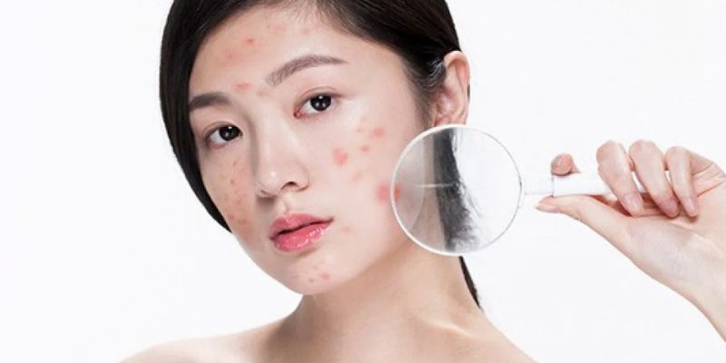 Nguyên Nhân Gây Mụn Và Cách Cải Thiện Trình Trạng Da Mụn