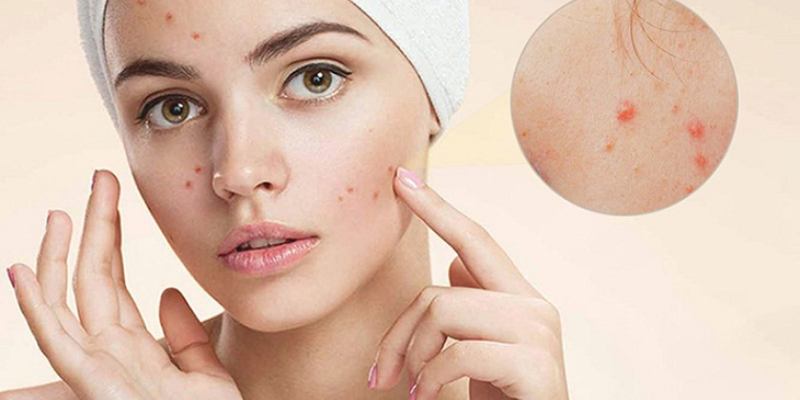 Nguyên Nhân Gây Mụn Và Cách Cải Thiện Trình Trạng Da Mụn